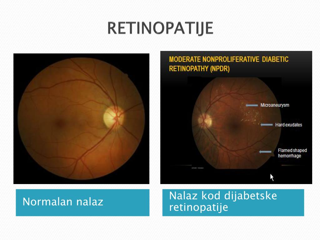 PPT - Akutne i hronične komplikacije dijabetes melitus-a PowerPoint ...