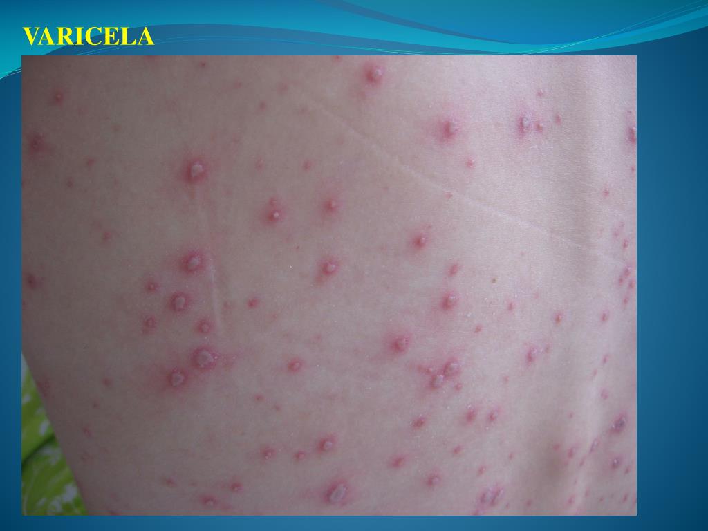 PPT - VARICELA - boală infecţioasă a copilului dată de VZV ...