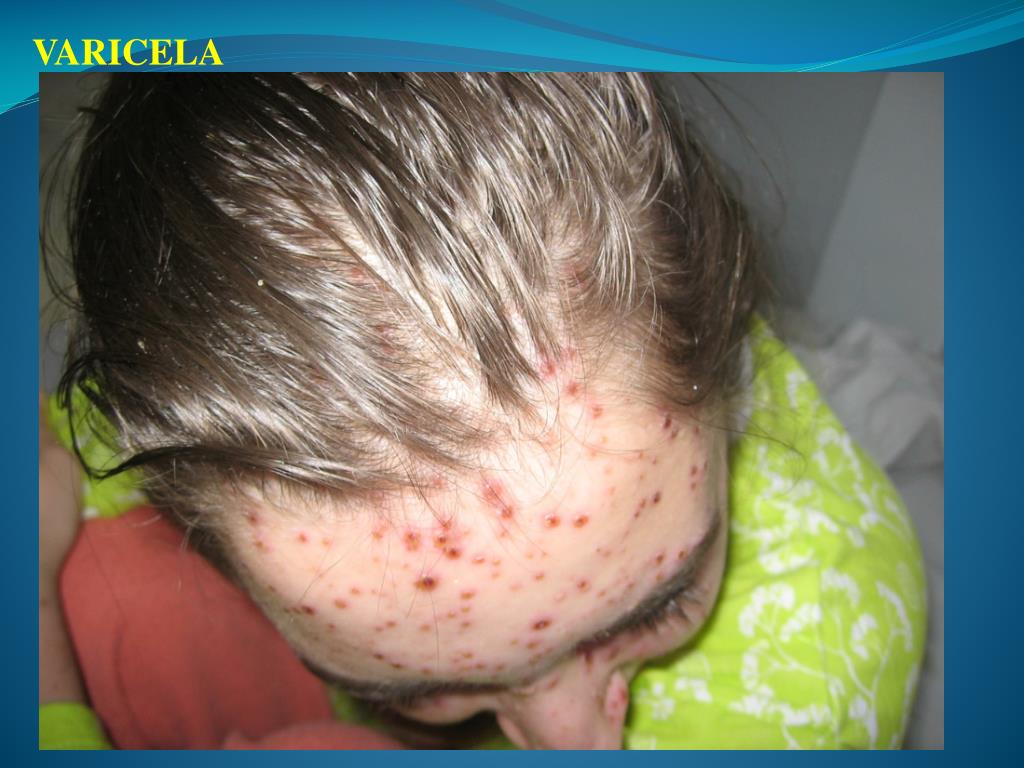 PPT - VARICELA - boală infecţioasă a copilului dată de VZV ...