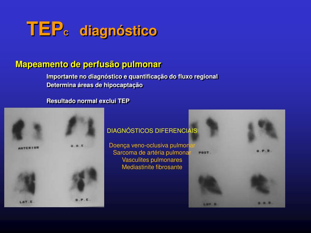 PPT - TROMBOEMBOLISMO PULMONAR CRÔNICO PowerPoint Presentation, free ...