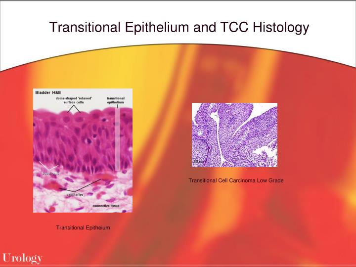 PPT - Kidney Cancer – RCC & TCC PowerPoint Presentation - ID:2118255