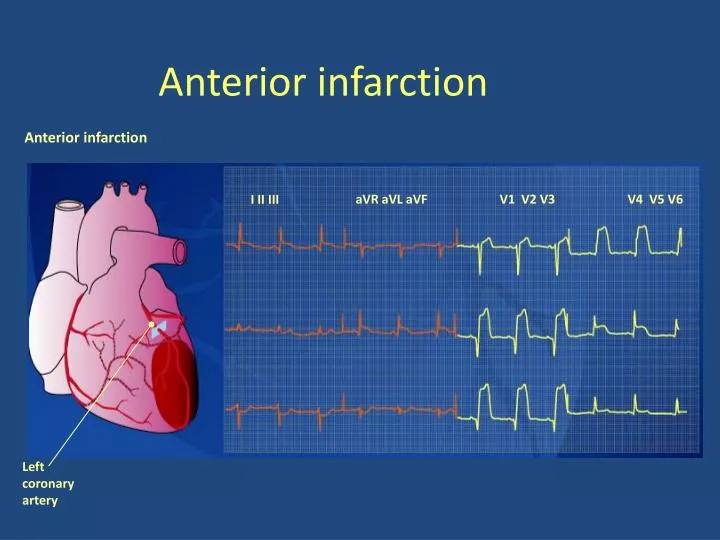 PPT - Anterior infarction PowerPoint Presentation, free download - ID ...