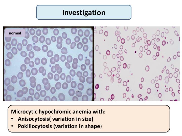 PPT - ANEMIA PowerPoint Presentation - ID:2122031