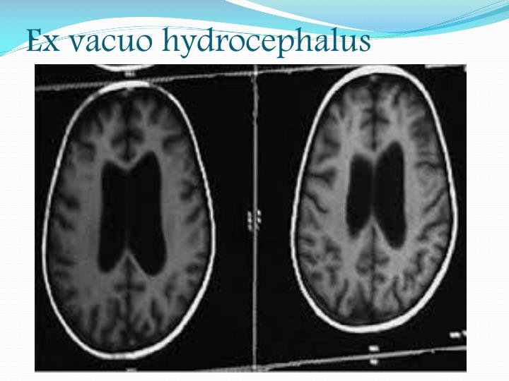 PPT - HYDROCEPHALUS PowerPoint Presentation - ID:2122056