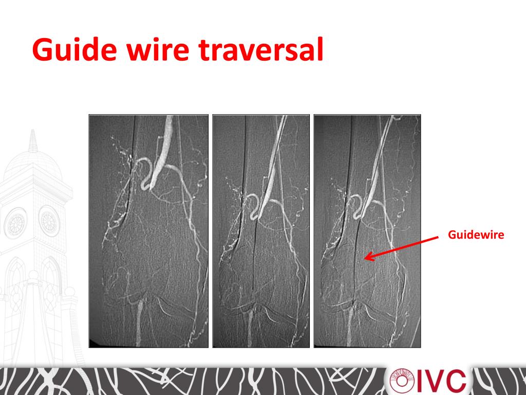 PPT - Endovascular Treatment for Acute Limb Ischemia PowerPoint ...