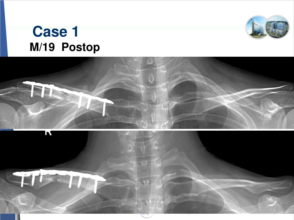 PPT - Clavicle fracture operative treatment(MIPO) PowerPoint ...