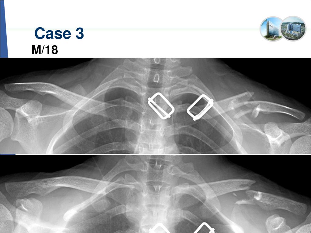 PPT - Clavicle fracture operative treatment(MIPO) PowerPoint ...