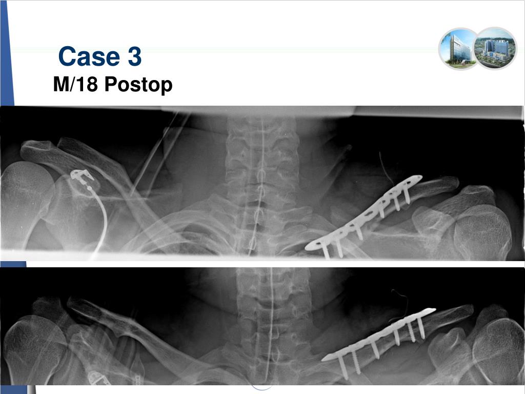 PPT - Clavicle fracture operative treatment(MIPO) PowerPoint ...