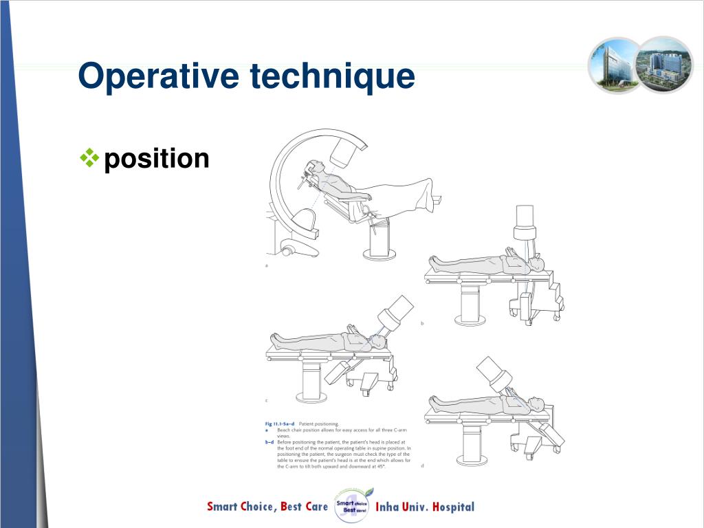 PPT - Clavicle fracture operative treatment(MIPO) PowerPoint ...