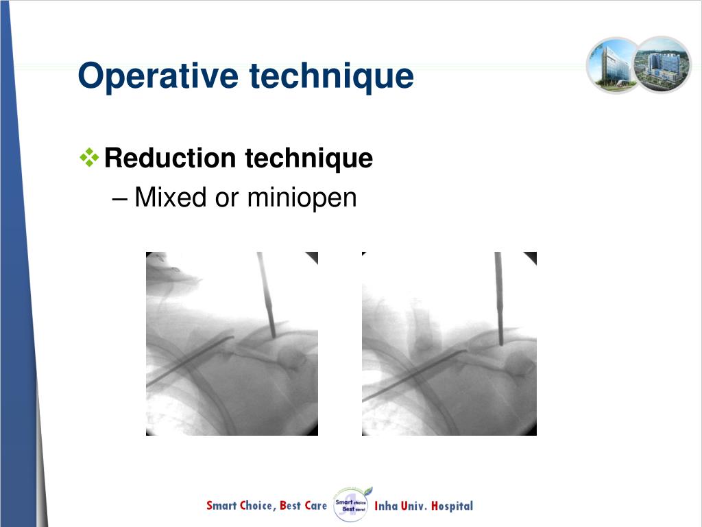 PPT - Clavicle fracture operative treatment(MIPO) PowerPoint ...