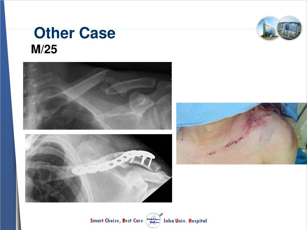 PPT - Clavicle fracture operative treatment(MIPO) PowerPoint ...