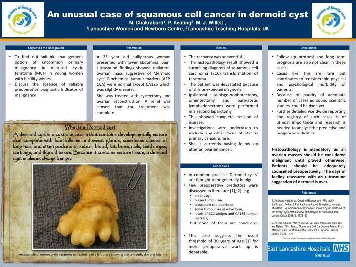 PPT - An unusual case of squamous cell cancer in dermoid cyst ...