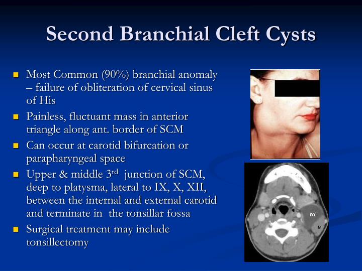 Branchial Cleft Cyst Diagram