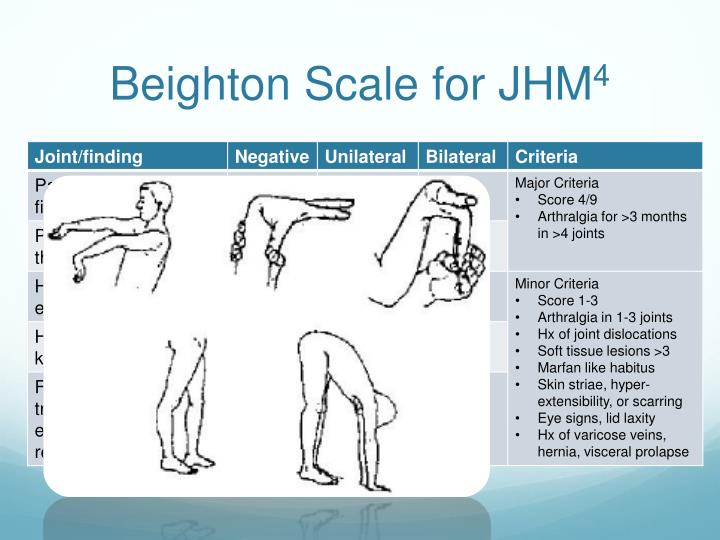 PPT - Ehlers- Danlos Syndrome (EDS) PowerPoint Presentation - ID:2124448