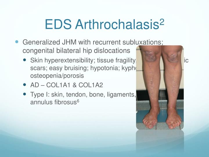 PPT - Ehlers- Danlos Syndrome (EDS) PowerPoint Presentation - ID:2124448