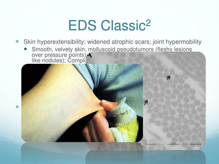 PPT - Ehlers- Danlos Syndrome (EDS) PowerPoint Presentation - ID:2124448