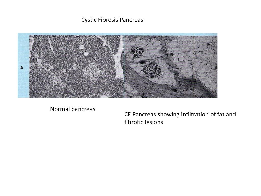 PPT - Cystic Fibrosis (CF) - gene location PowerPoint Presentation ...