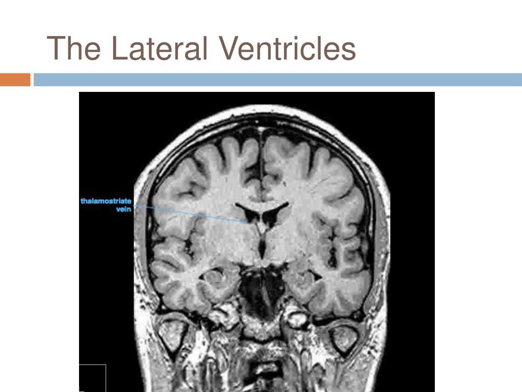 PPT - Anatomy of the Cerebral Ventricles PowerPoint Presentation, free ...