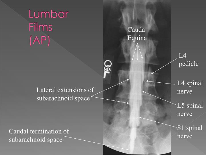 PPT - Myelography PowerPoint Presentation - ID:2131458