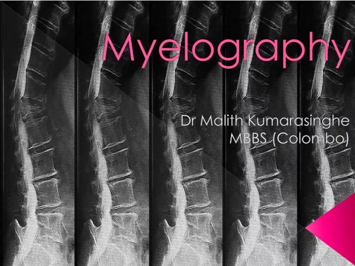 PPT - Myelography PowerPoint Presentation, free download - ID:2131458