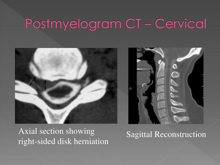 PPT - Myelography PowerPoint Presentation - ID:2131458