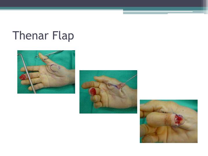 PPT - Local Hand Flaps PowerPoint Presentation - ID:2131691