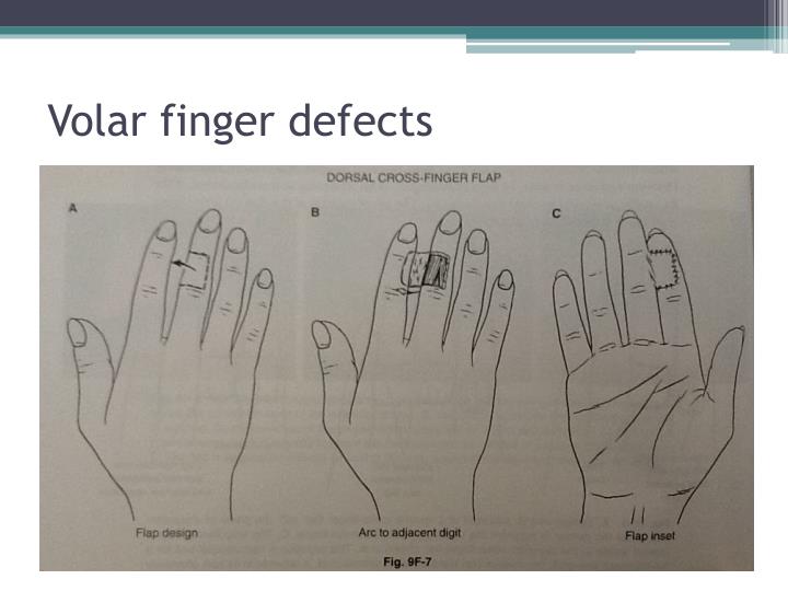 PPT - Local Hand Flaps PowerPoint Presentation - ID:2131691