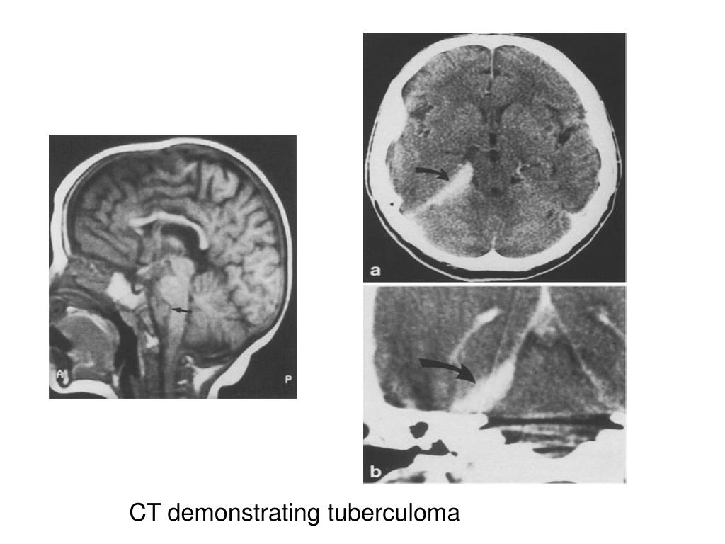 PPT - CEREBRAL TB AND OTHER CHRONIC CEREBRAL BACTERIAL INFECTION ...