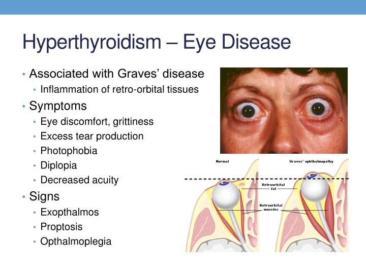 Ppt Thyroid Disease Powerpoint Presentation Id 2132906