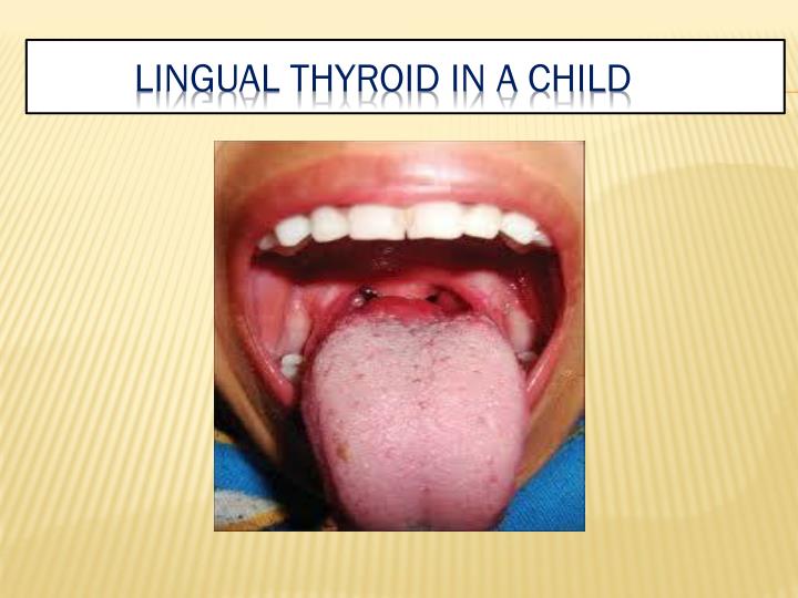 PPT - DISEASES OF THYROID GLAND 1 PowerPoint Presentation - ID:2133413