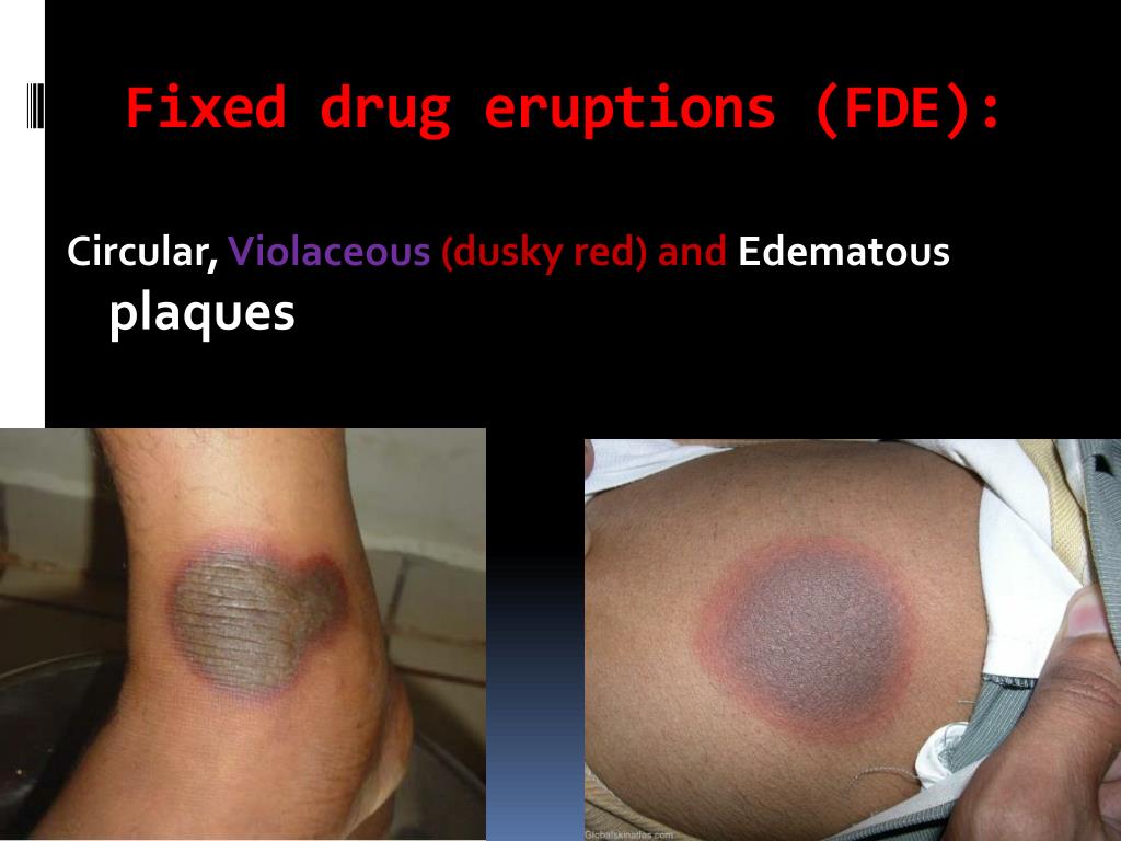 PPT - Drug eruptions By: Dr. Faraedon Kaftan School of Medicine ...