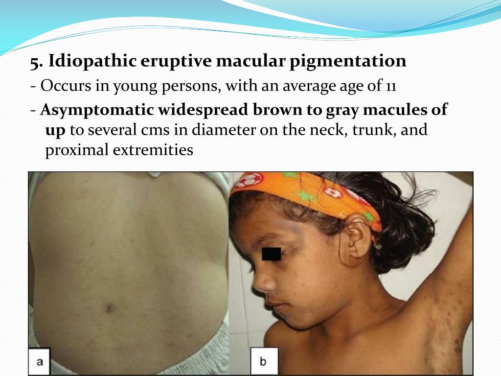 PPT - Lichen Planus and related conditions By: Dr. Faraedon Kaftan ...