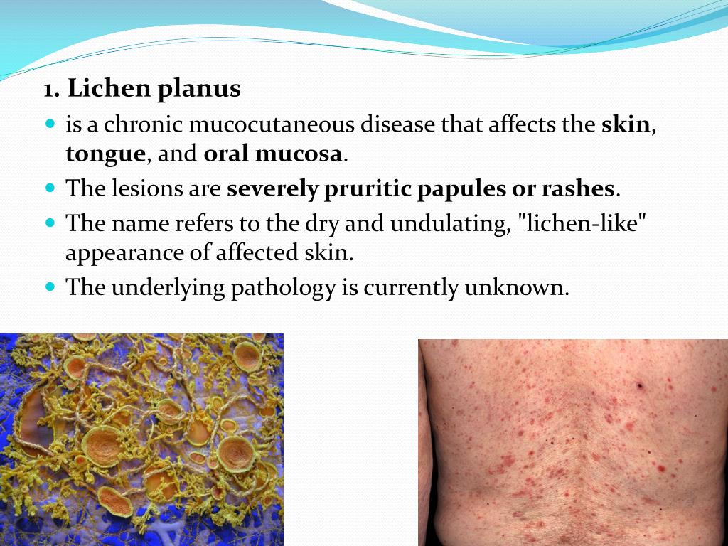 PPT - Lichen Planus and related conditions By: Dr. Faraedon Kaftan ...