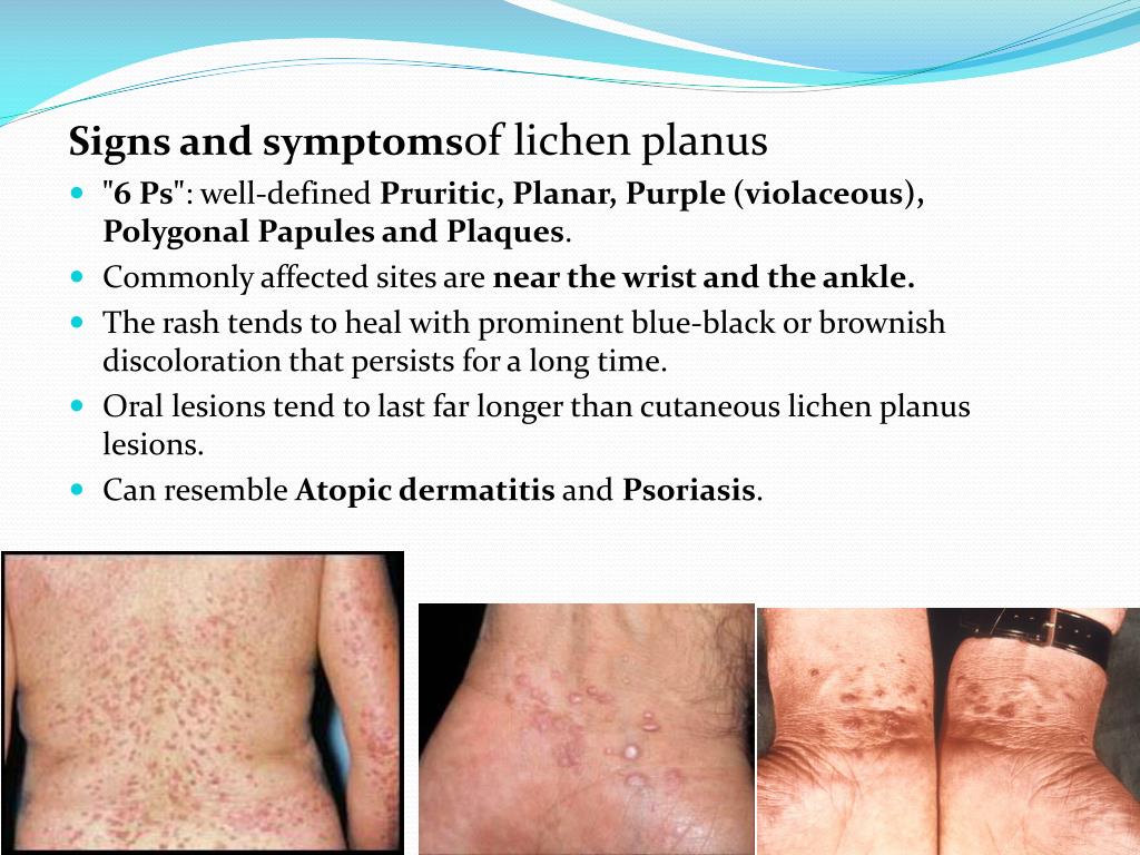 PPT - Lichen Planus and related conditions By: Dr. Faraedon Kaftan ...