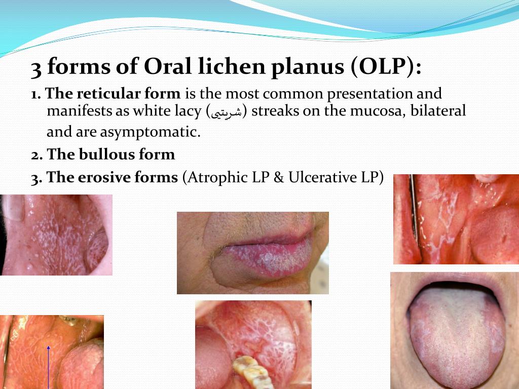 PPT - Lichen Planus and related conditions By: Dr. Faraedon Kaftan School of Medicine PowerPoint ...
