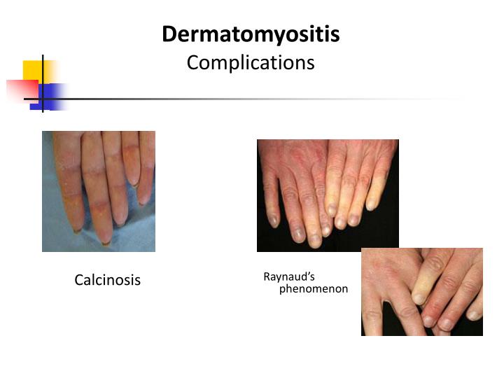 PPT - SKIN MANIFESTATIONS IN RHEUMATIC DISEASES AROMA 2011 PowerPoint ...