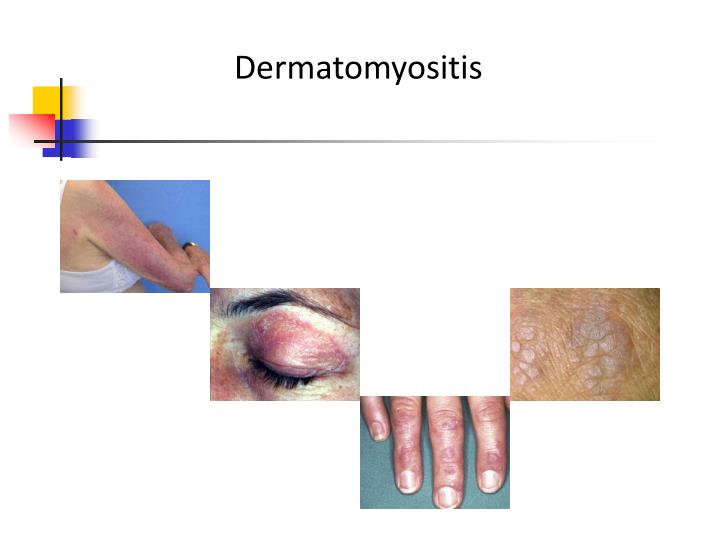 PPT - SKIN MANIFESTATIONS IN RHEUMATIC DISEASES AROMA 2011 PowerPoint ...
