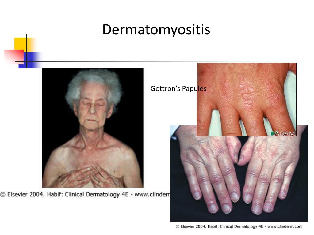PPT - SKIN MANIFESTATIONS IN RHEUMATIC DISEASES AROMA 2011 PowerPoint ...