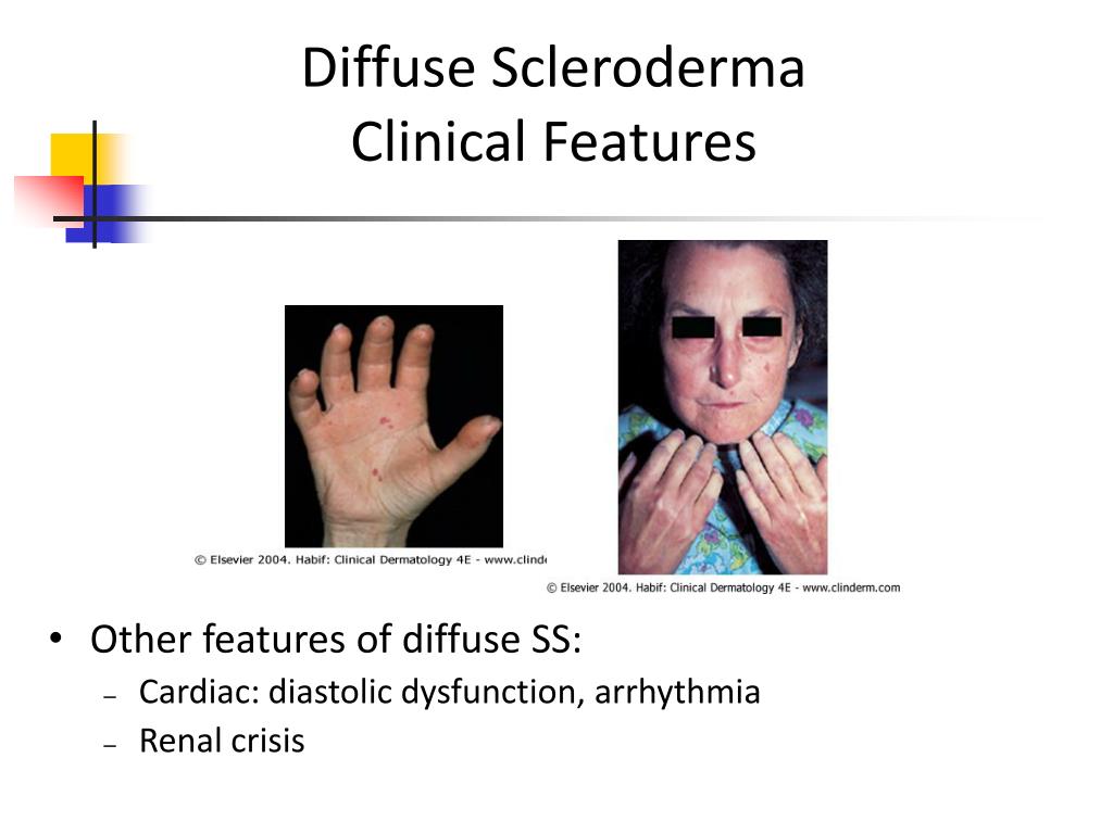 PPT - SKIN MANIFESTATIONS IN RHEUMATIC DISEASES AROMA 2011 PowerPoint ...