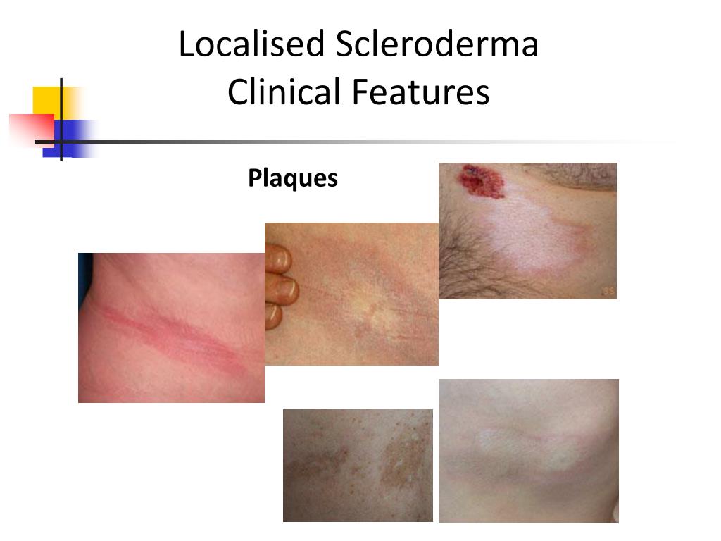 PPT - SKIN MANIFESTATIONS IN RHEUMATIC DISEASES AROMA 2011 PowerPoint ...
