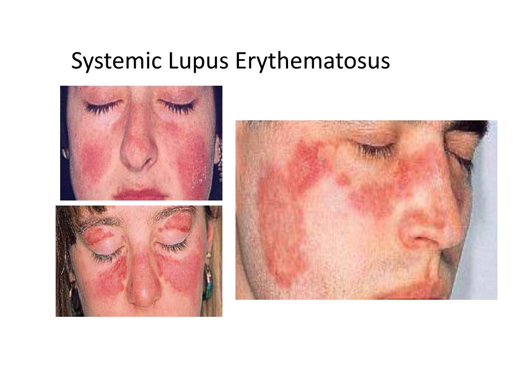 PPT - SKIN MANIFESTATIONS IN RHEUMATIC DISEASES AROMA 2011 PowerPoint ...