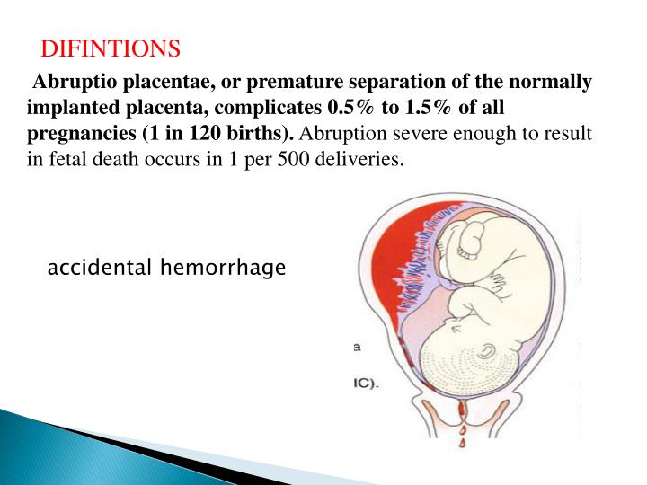 PPT - ABRUPTIO PLACENTAE PowerPoint Presentation - ID:2136352