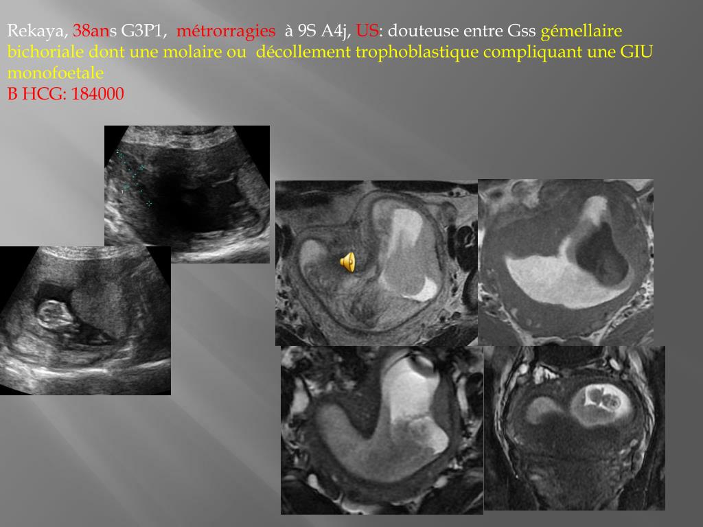 PPT - IRM dans les urgences gynécologiques et obstétricales PowerPoint ...
