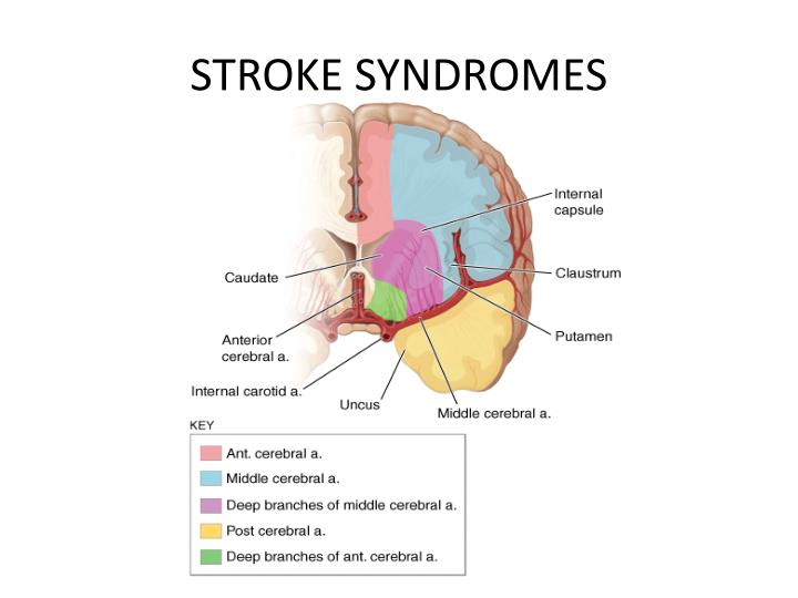 PPT - Stroke Syndromes PowerPoint Presentation - ID:2136516