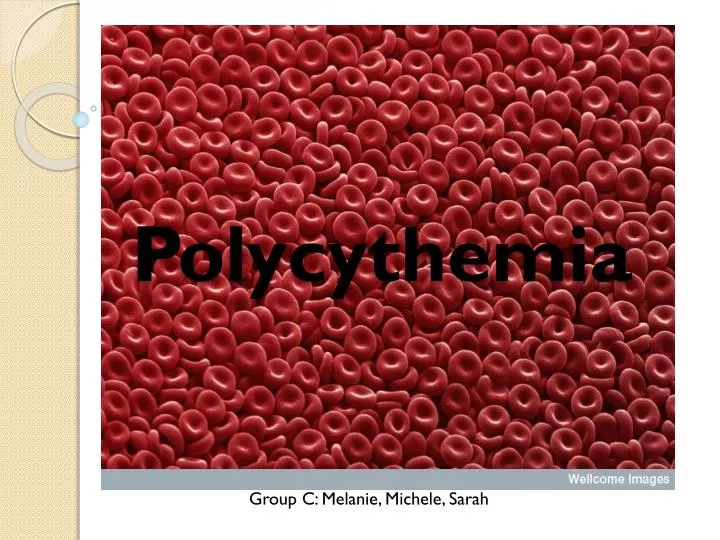 PPT - Polycythemia PowerPoint Presentation, free download - ID:2136757