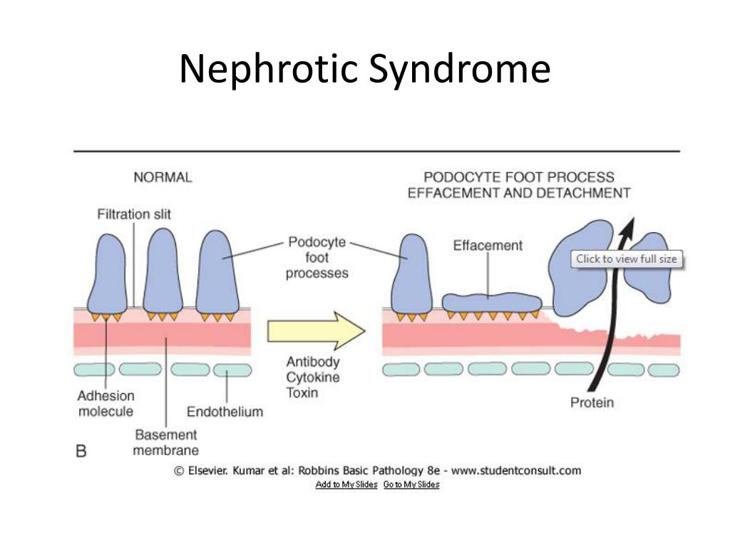 PPT - Cardinal Manifestation of Disease: EDEMA PowerPoint Presentation ...