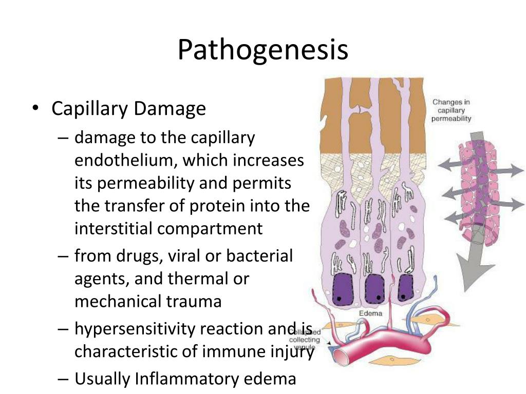 PPT - Cardinal Manifestation of Disease: EDEMA PowerPoint Presentation ...