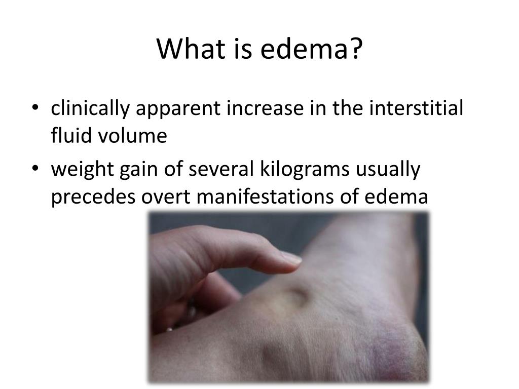 PPT - Cardinal Manifestation of Disease: EDEMA PowerPoint Presentation ...