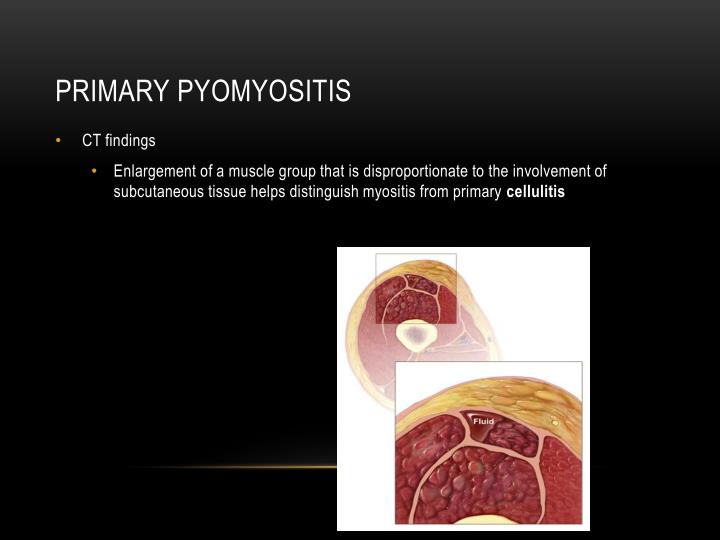 PPT - Imaging approach to a patient with an acute swolen leg ...