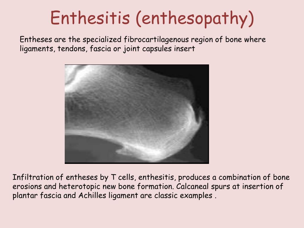 PPT - Seronegative Arthritis Or Spondyloartropaties PowerPoint ...